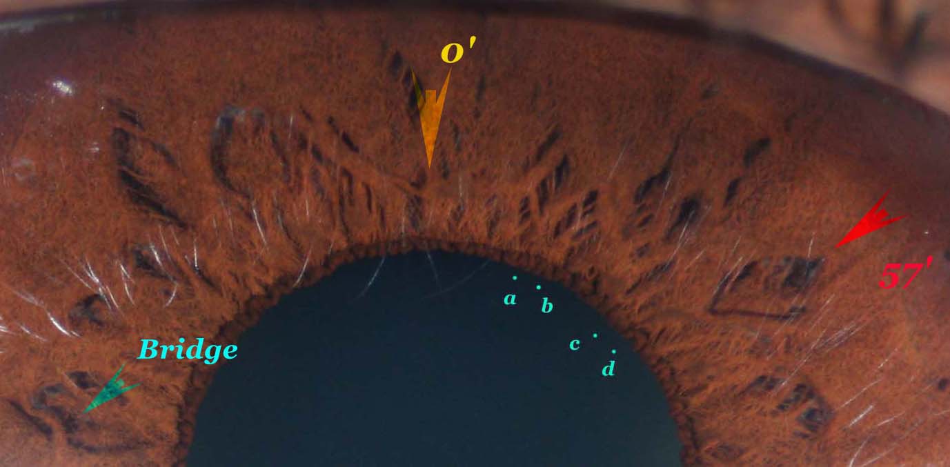 Modern & Multidimensional Iridology: Misshapen Collarette - Rx - (emran ...