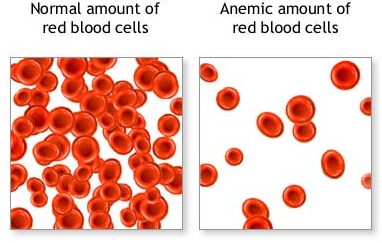 Vitamin untuk Extra Sihat!: ANEMIA - KURANG DARAH MERAH
