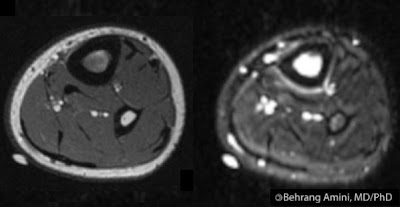 Roentgen Ray Reader: Fredericson Grading of Tibial Stress Reaction