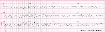 ECG Educator Blog : Ventricular Fibrillation (VF)