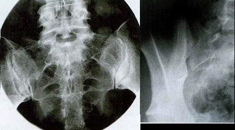 Estudo Radiográfico : ROTINA DE ARTICULAÇÕES SACRO-ILÍACAS