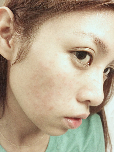 3 Things To Do When You Have Sudden Acne Outbreak ~ Health Channel
