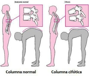 CLINICA ZAFRILLA SERVICIOS MEDICOS Y FISIOTERAPIA: CIFOSIS: CAUSAS ...