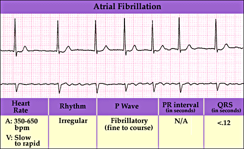 Atrial Fibrilasi | INA - ECG