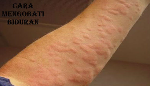 Cara Mengobati Biduran Hingga Tuntas Agar Tidak Kambuh Lagi - Tips ...