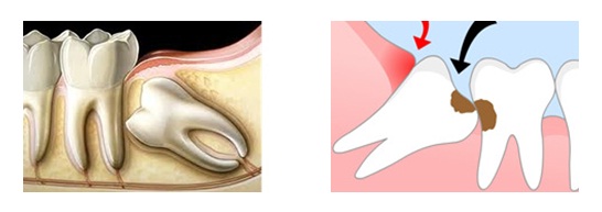 Dokter Gigi ANTONY: ODONTEKTOMI (Pencabutan Gigi Bungsu)