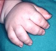 Nuestro esqueleto: Miembro superior: Malformaciones óseas de la mano