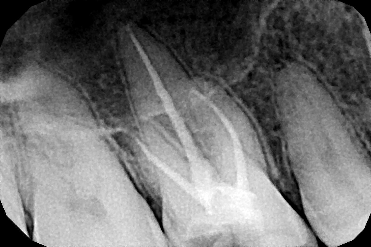 Root Canal Fillings