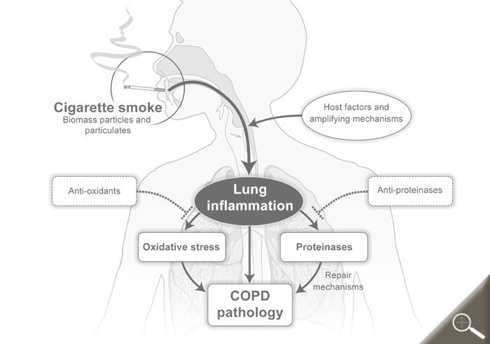 Chronic Obstructive Pulmonary Disease: Pathogenesis