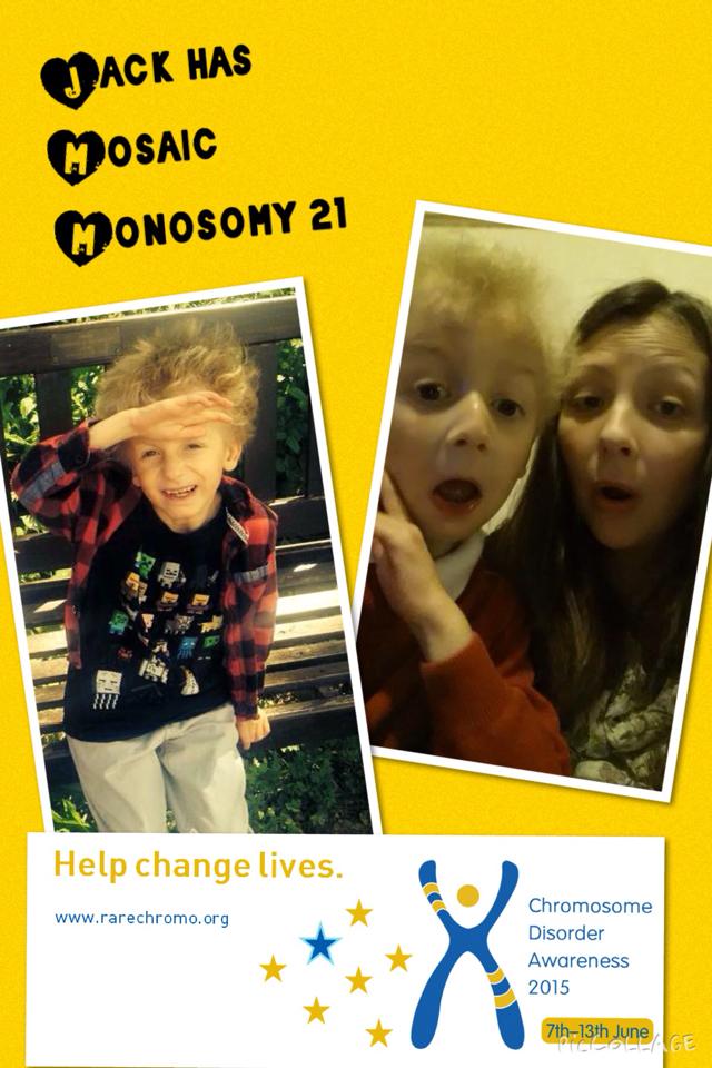 Raising a son with Mosaic Monosomy 21 + 6 girls: Rare chromosome ...