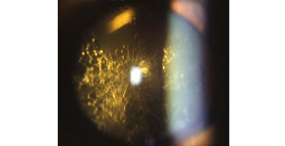 A Patient’s Guide to Cataract Surgery Part 4: If you chose to wait ...