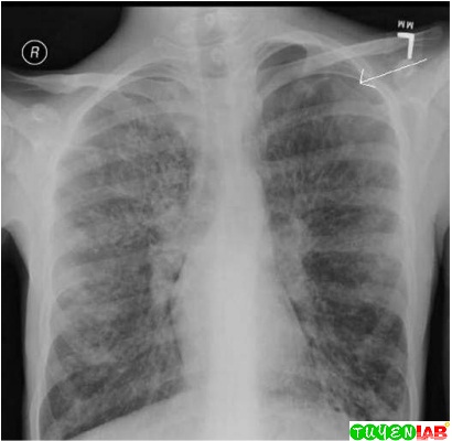 [Pediatric] Atlas of Cystic fibrosis | Free Medical Atlas