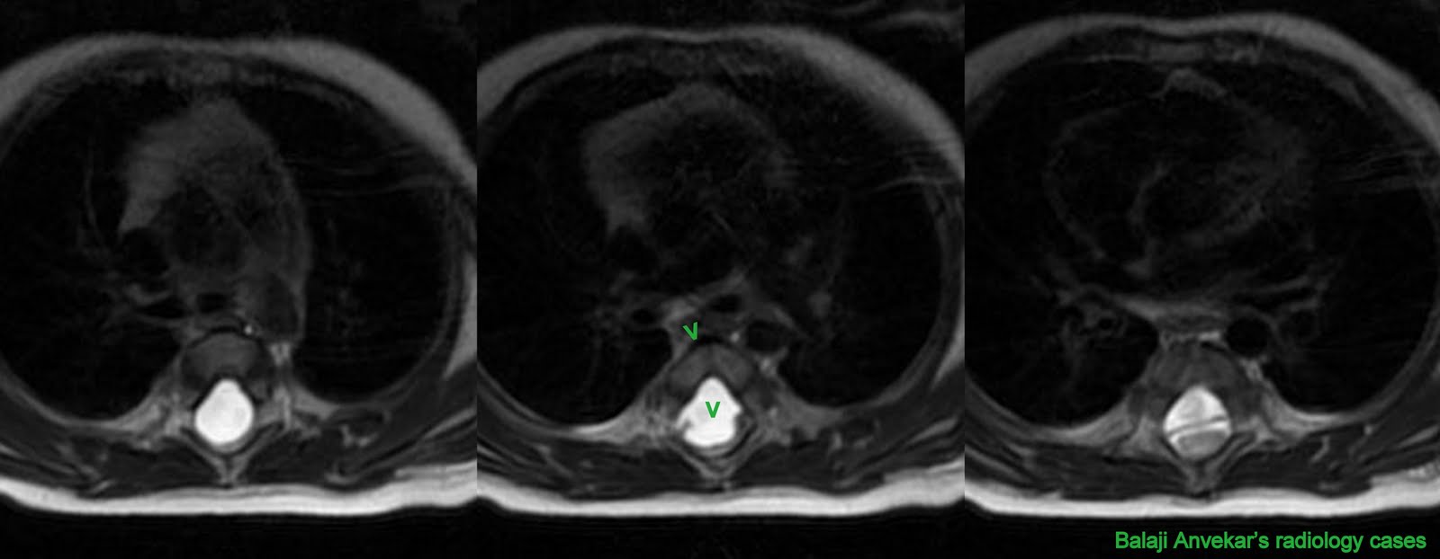 Dr Balaji Anvekar Frcr Neuroenteric Cyst Mri