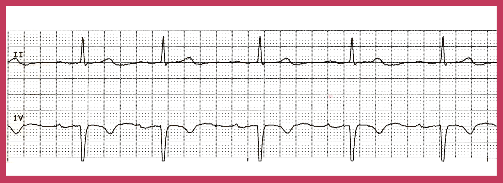 Basic EKG Rhythm Test 21 (Heart Block Challenge)