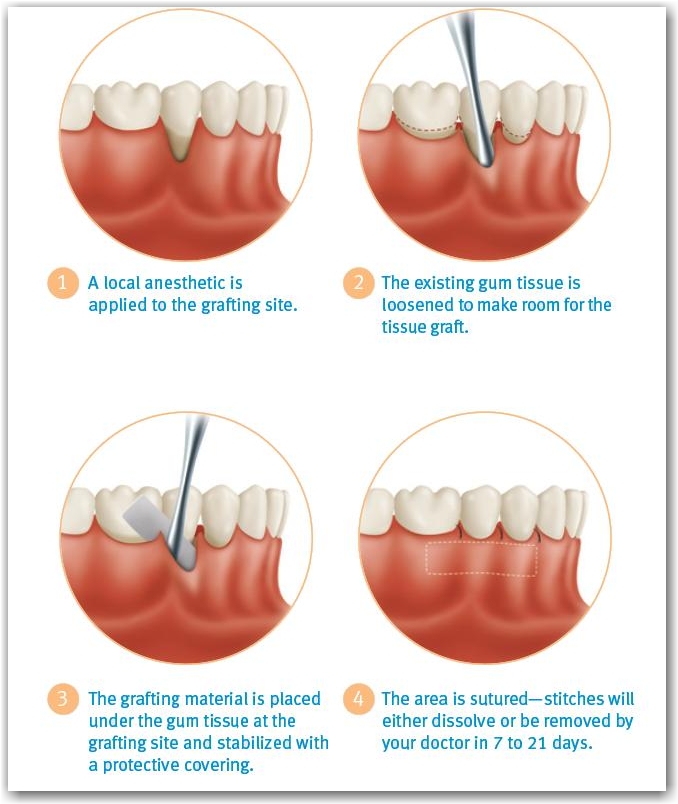 Berdy Dental Group: Soft Tissue Graft