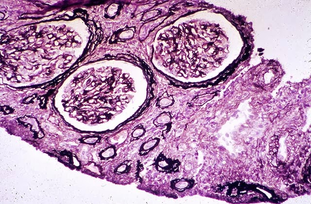 TRATAMIENTO NATURAL NEFRITIS (INFECCION EN LOS RIÑONES) | EL CLUB DEL ...