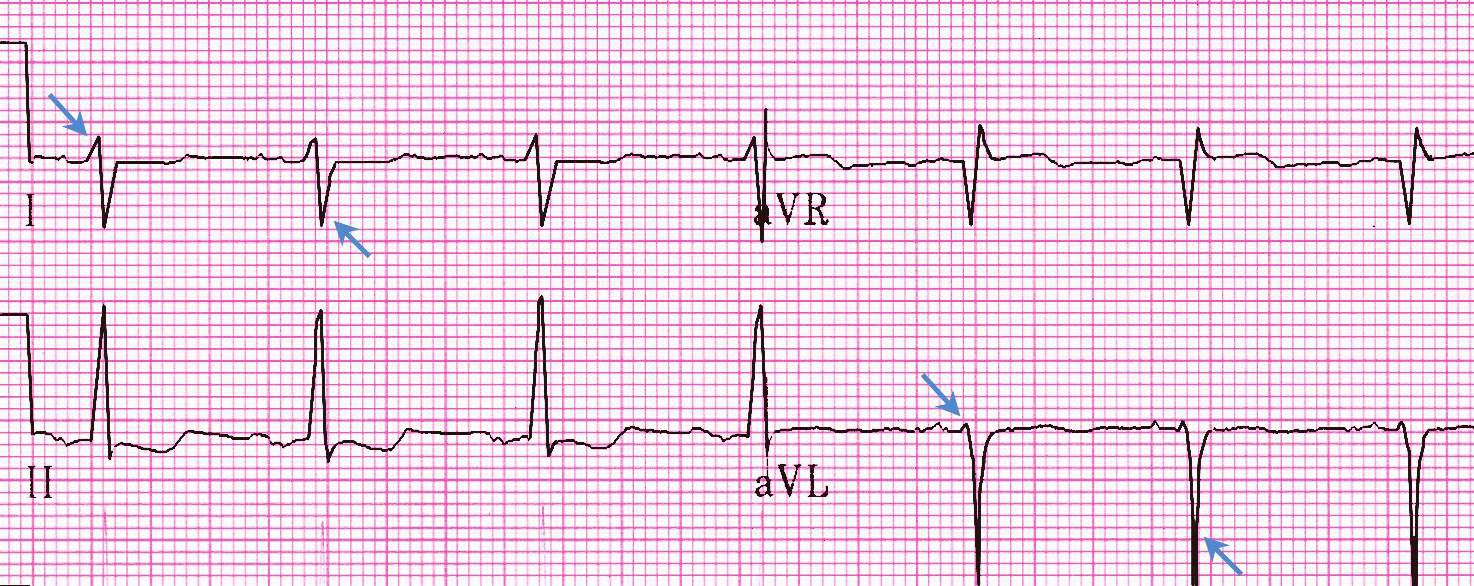Study Medical Photos: Left Posterior Fascicular Block - ECG