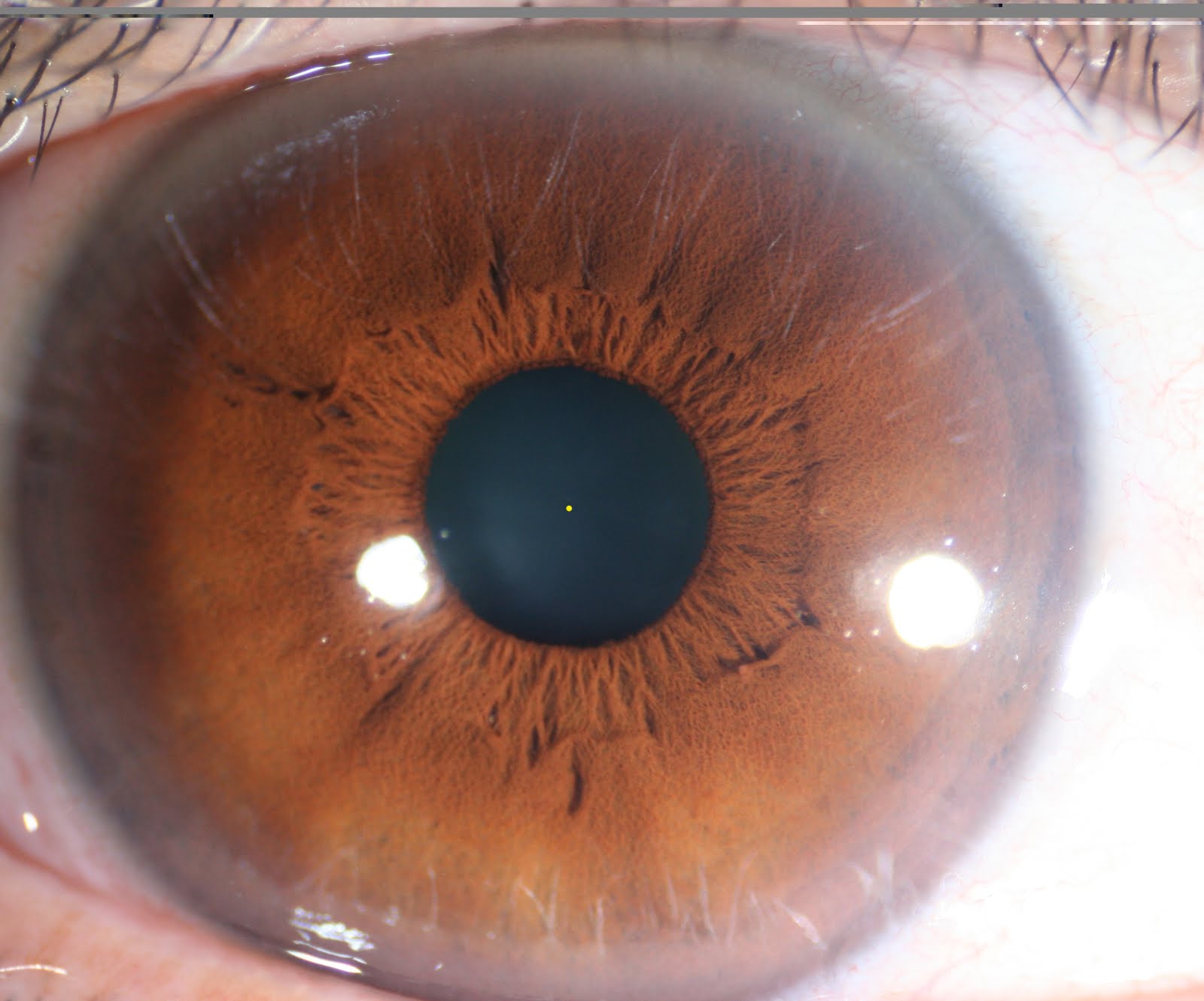 Modern & Multidimensional Iridology: Solitary Melanin Pigment ...