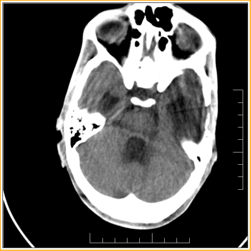 Post traumatic hydrocephalus-CT - Sumer's Radiology Blog