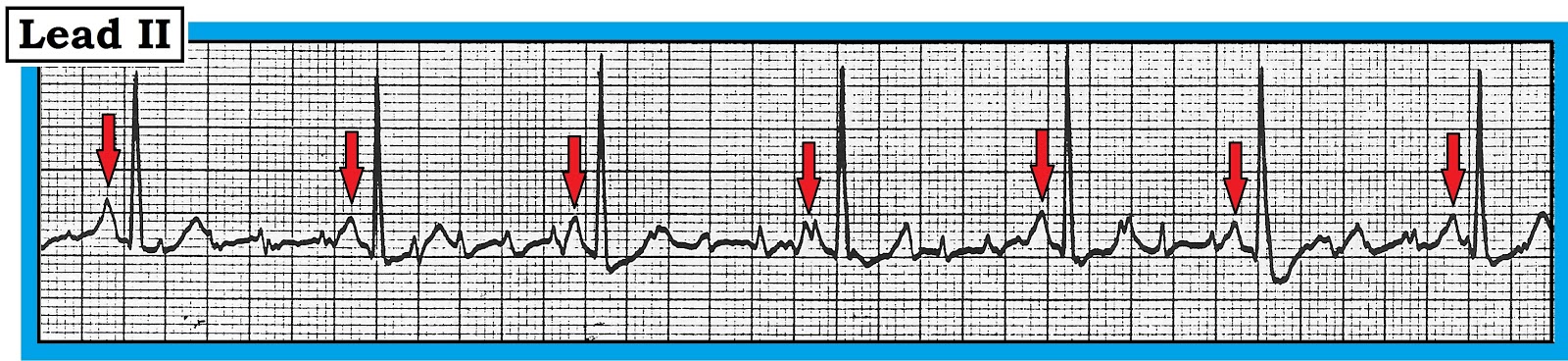 Ecg Interpretation Ecg Blog 139 Atrial Flutter Av Block Artifact Sinus Rhythm