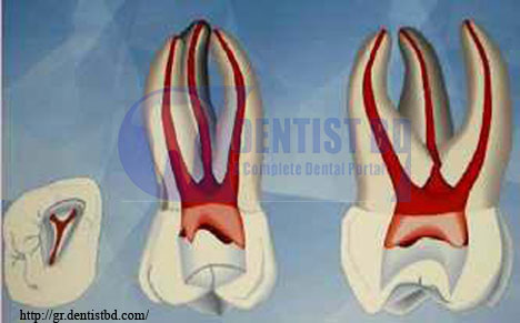 HU TU TU: maxillary third molar