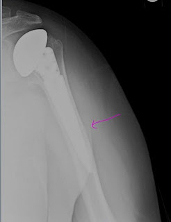 How to read X-ray after the TSA (total shoulder arthroplasty) - Sumer's ...
