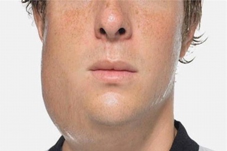 ¿Qué son las paperas? ~ El Médico Contesta