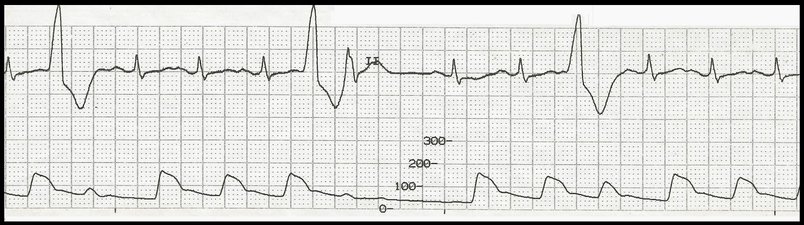 Practice EKG Rhythm Strips 216