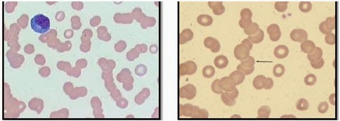 Atlas de Hematología : Células de rouleaux