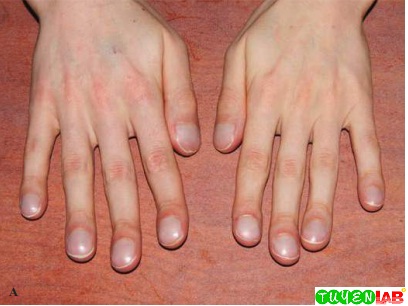 [Pediatric] Atlas of Clubbing and cyanosis | Free Medical Atlas