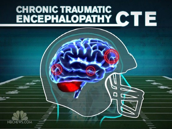 Sports Biz U: Will the NFL Fight against CTE?