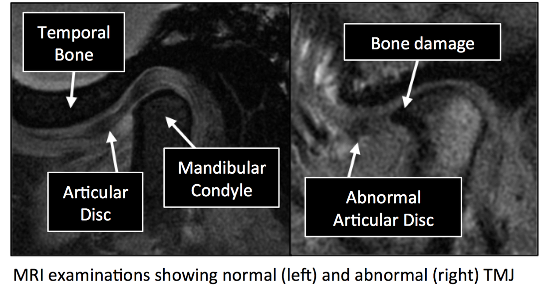 Radiology Anatomy Images Temporomandibular Joint Mri Anatomy