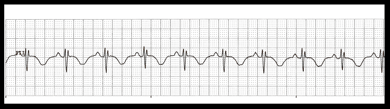 Various Normal Sinus Rhythms