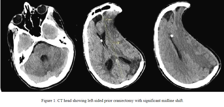 pediatric neurology: The sydrome of the trephined