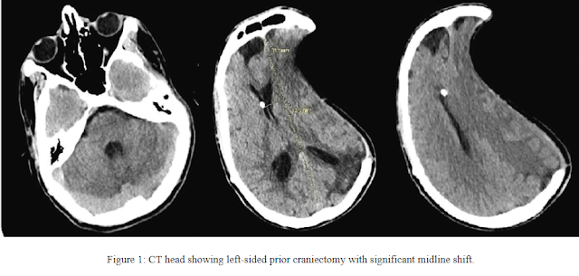 pediatric neurology: The sydrome of the trephined