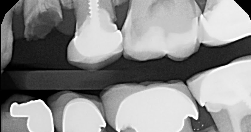 Dental tips-Minimize the stress!: Why do I need to replace this crown ...