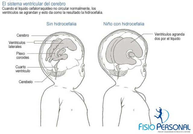 Fisiopersonal: HIDROCEFALIA