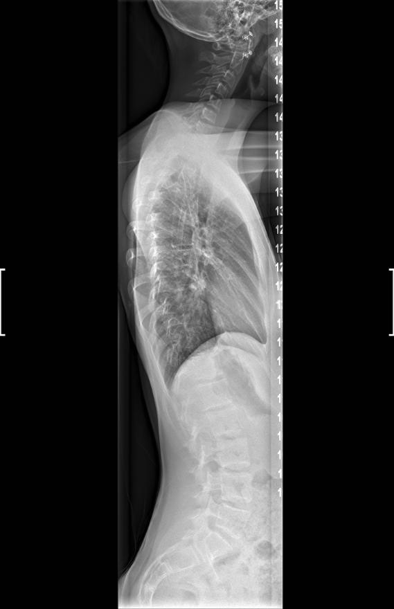 Anneroos Scoliose: Röntgenfoto's