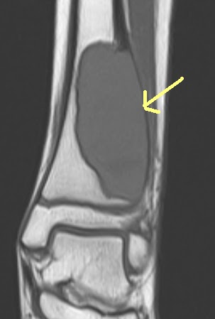 mricases: Aneurysmal Bone Cyst