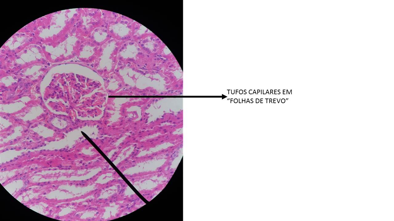 HISTOLOGIA90: RIM NORMAL E GLOMERULONEFRITES