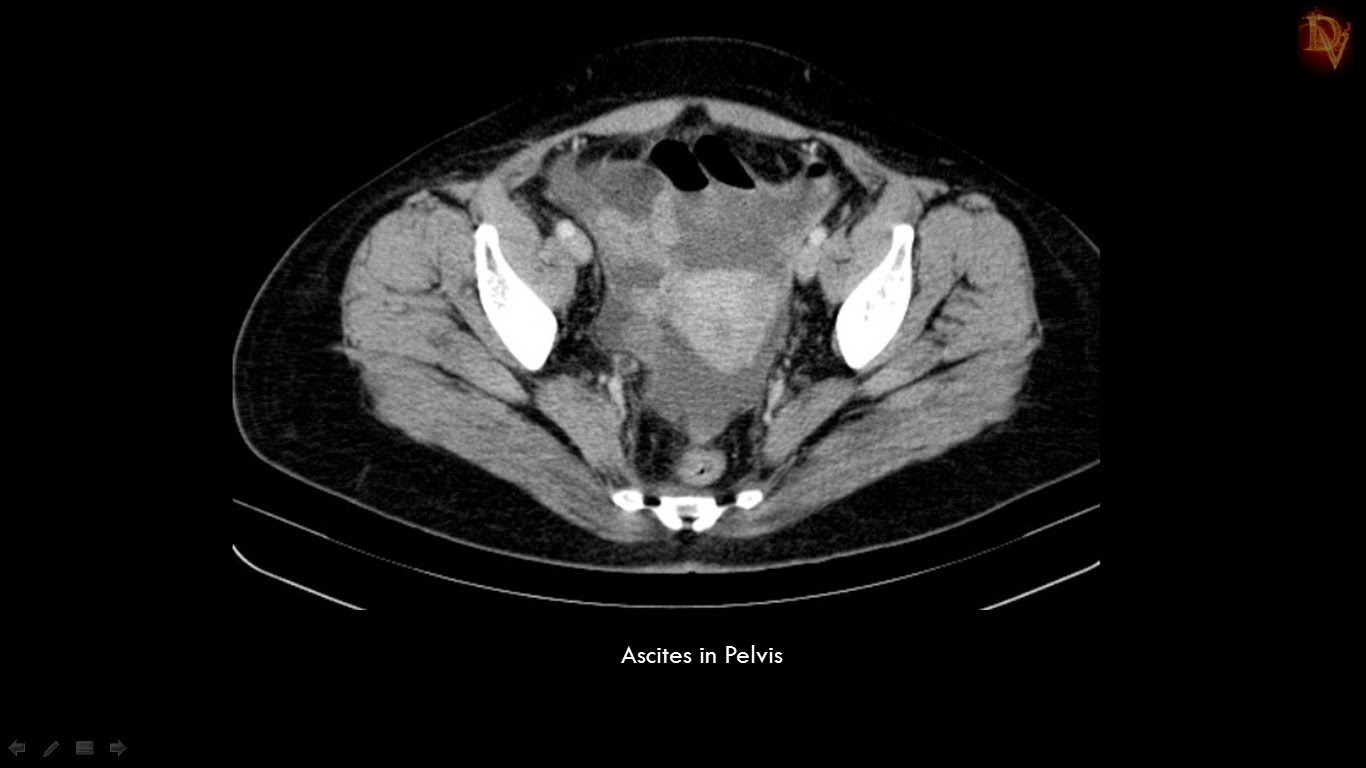 Ultimate Radiology : Acute Necrotizing Pancreatitis