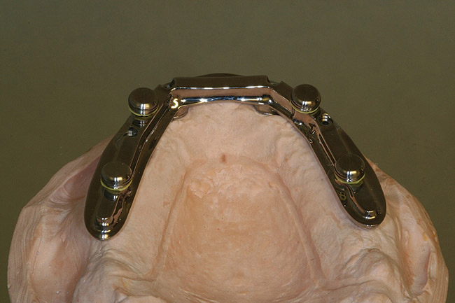 Implant Supported Bar Overdenture parts and cost - Bauer Smiles