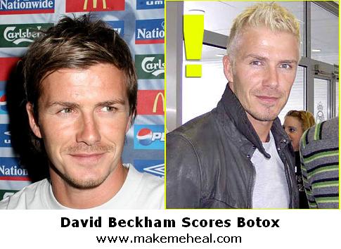 David Beckham Plastic Surgery Before and After Nose Job and Lips ...