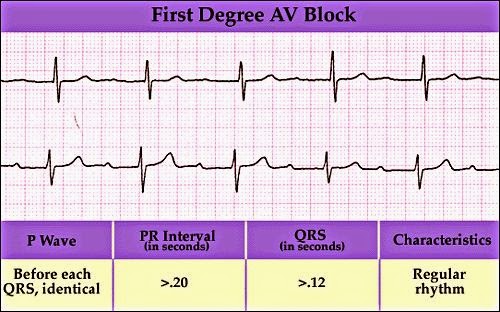 First Degree AV Block | INA - ECG