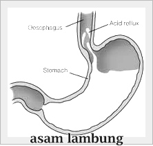 obat tradisional asam lambung | manfaat dari obat tradisional