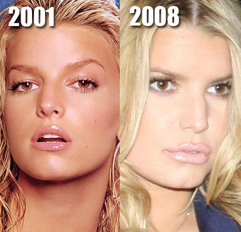 Jessica Simpson Plastic Surgery Before and After Lips and Collage ...