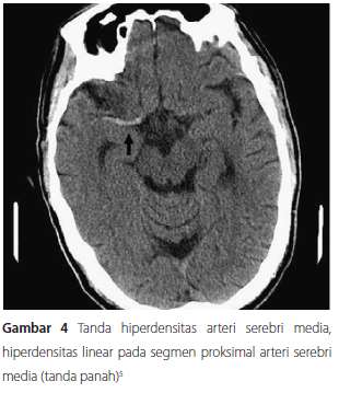 Gambaran CT Scan Non-Kontras pada Stroke Iskemik ~ Seputar Kedokteran
