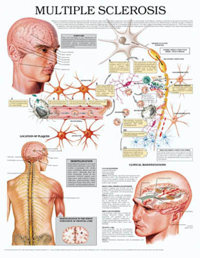 Esclerosis Multiple: Esclerosis Múltiple