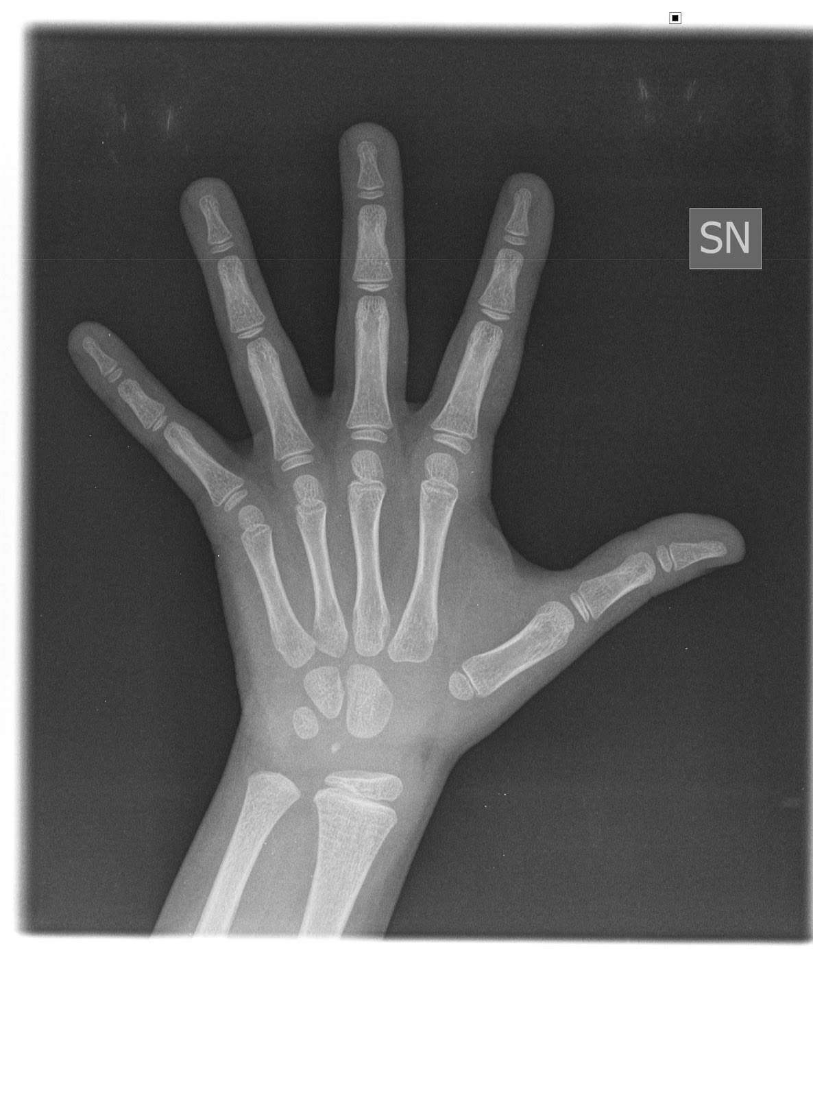 Gelastic Seizures Bone Age X Ray