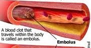 Fat embolism - causes and clinical manifestations Of fat embolism